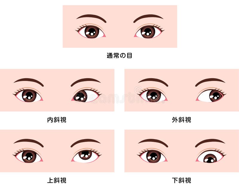 Types of Strabismus Vector Illustration Stock Vector - Illustration of ...