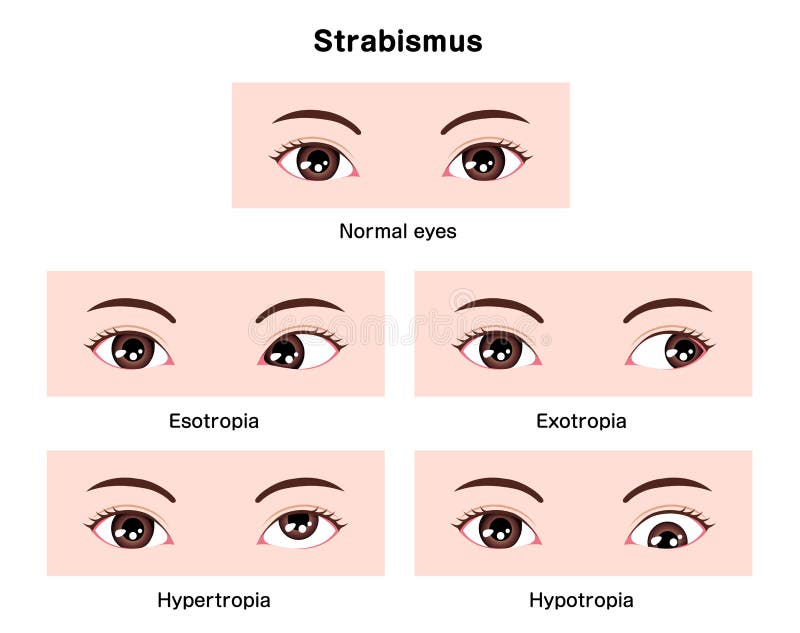 Types of strabismus. Esotrobia and Exotrobia Stock Vector ...