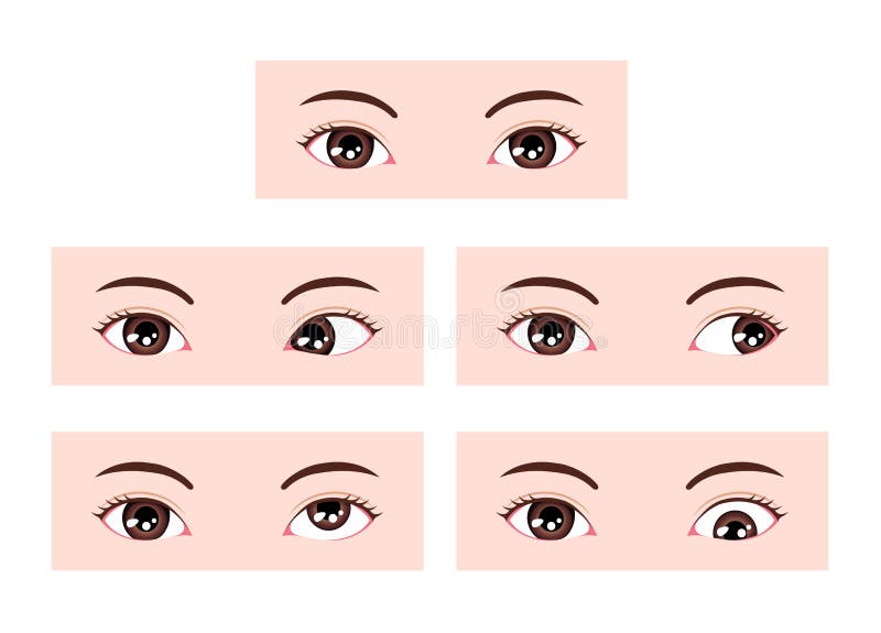 Types of strabismus-1 stock vector. Illustration of optical - 136471526