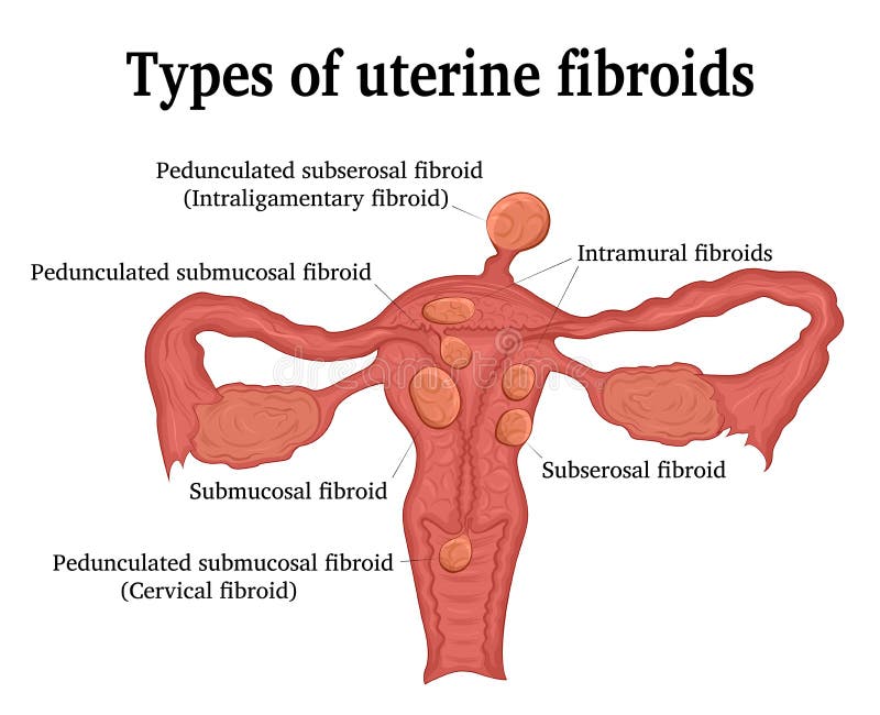 Types Of Uterine Fibroids Stock Vector Illustration Of Reproductive