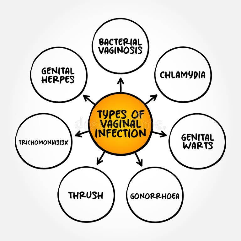 Vaginal Infection Mind Map Stock Illustrations – 4 Vaginal Infection ...