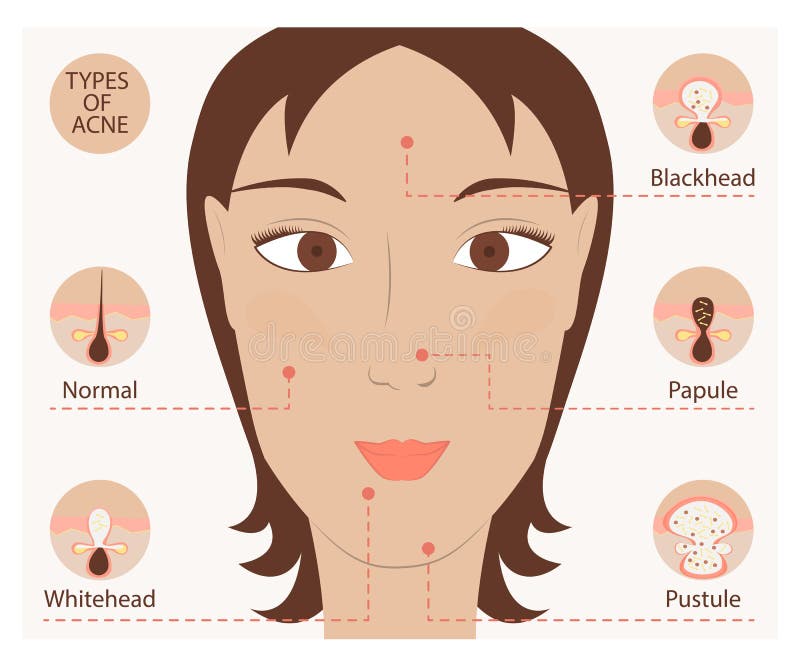 Types van acne en pukkels vector illustratie. Illustration of gezond ...