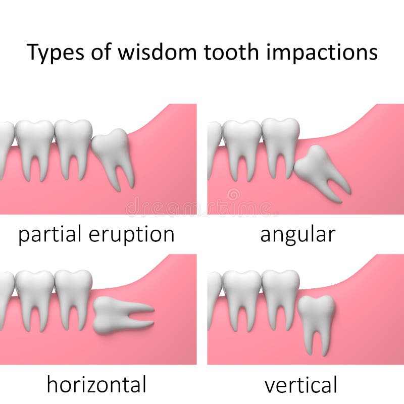 Types of Wisdom Tooth Impactions, White Background, Collage, 3D-render ...