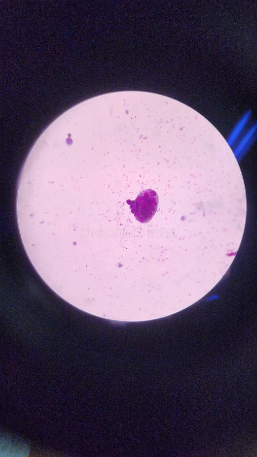 Tzanck Cells - Multinucleated Giant Cell Stock Image - Image of ...