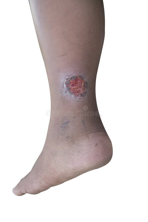 Ulcères de jambe image stock. Image du soin, causes, douloureux - 79605913