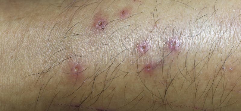 Ulcères De Jambe, Gangrene Causé Image stock - Image du veineux, ulcère ...