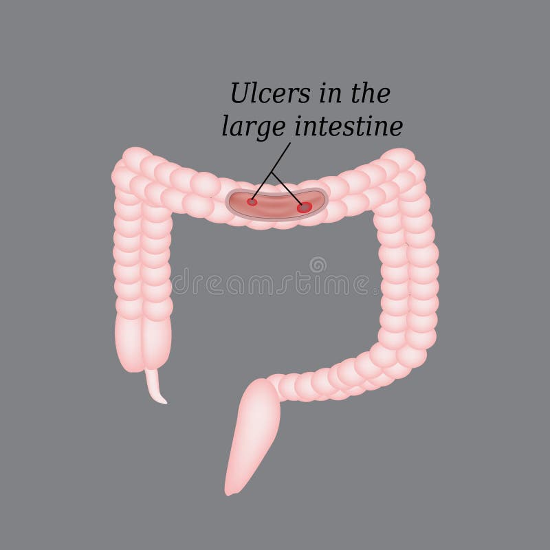 Ulcer in the Intestine. Ulcers in the Colon Stock Vector - Illustration ...