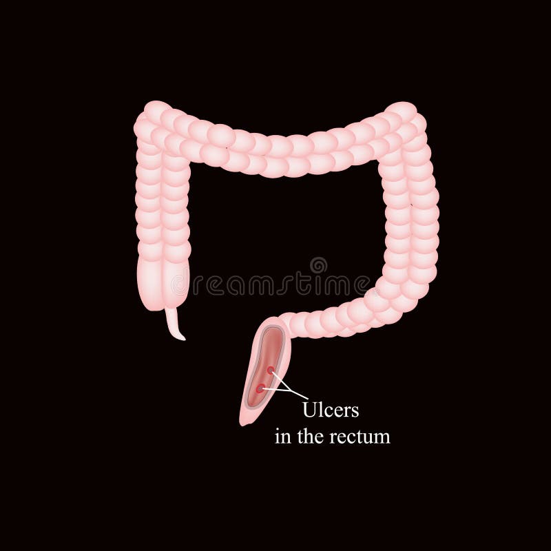 An Ulcer in the Rectum. Ulcers in the Intestines Stock Illustration ...