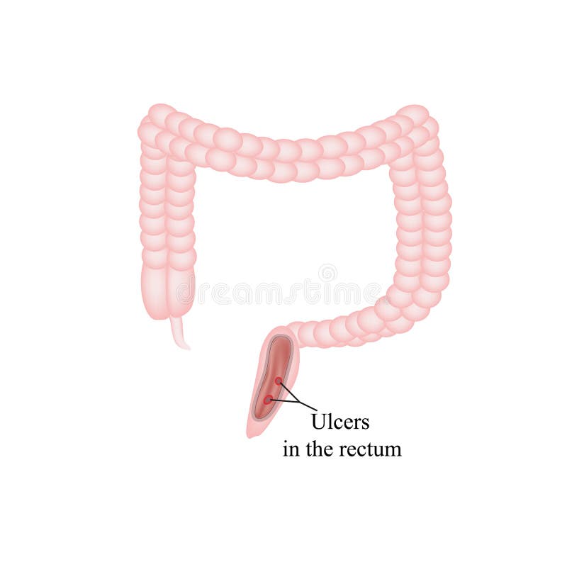 An Ulcer in the Rectum. Ulcers in the Intestines Stock Illustration ...