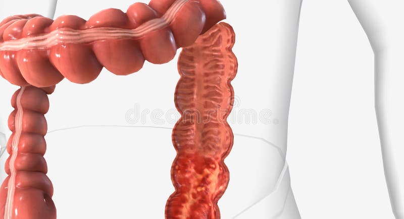 Ulcerative Colitis Chronic Inflammation of the Lining of the Large ...
