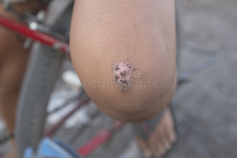 Ulcere della gamba fotografia stock. Immagine di incidente - 80750262