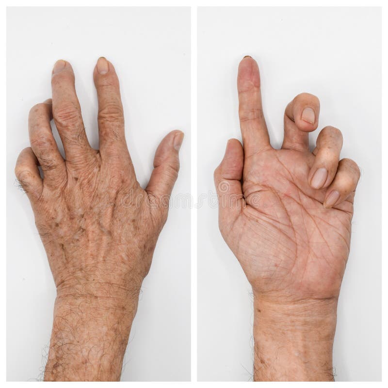 Ulnar Claw Hand of Asian Elder Man. Also Known As `spinster`s Claw ...