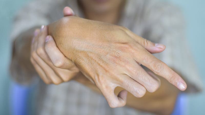 Ulnar Claw Hand of Asian Young Man. Also Known As & X27;spinster& X27;s ...