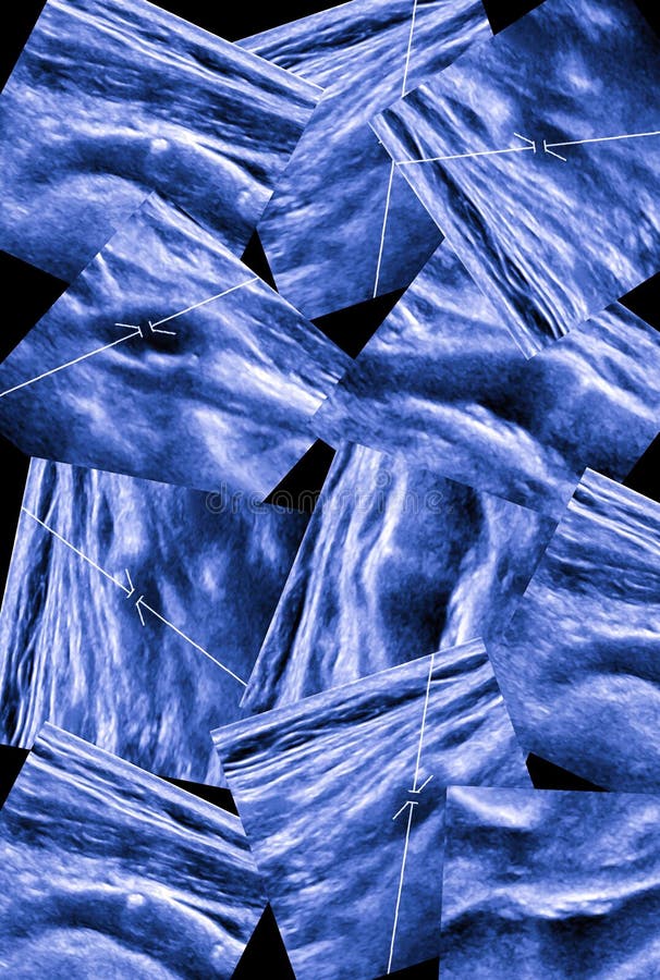 Ultrasone Klankbeeld Van De Slagader Van De Halsslagader Stock Foto ...