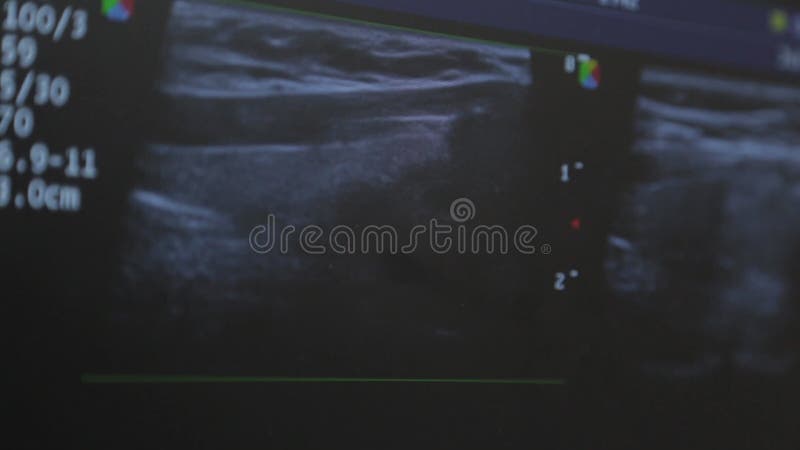 Ultrasound Device in a Medical Center. Screen Image. Stock Footage ...