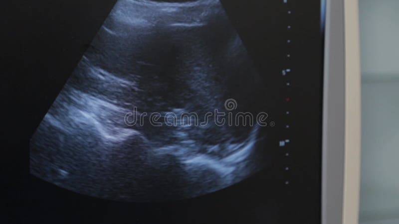 Ultrasound Device in a Medical Center. Screen Image. Stock Footage ...