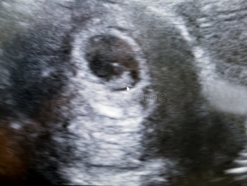 Ultrasound of Embryo at Sixth Week Stock Image - Image of pregnant ...