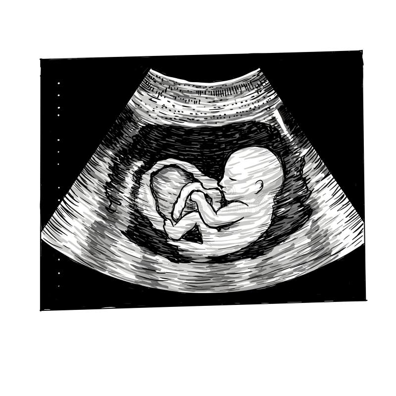 Ultrasound Image of a Fetus Showing Early Development Stock ...