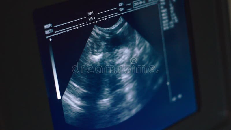 Ultrasound on Monitor. Ultrasound Image on Computer Monitor Screen ...