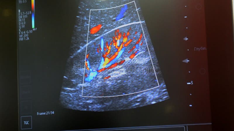 Ultrasound on Monitor. Ultrasound Image on Computer Monitor Screen ... Ultrasound on Monitor. Ultrasound Image on Computer Monitor Screen ...