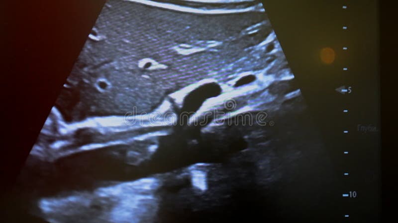 Ultrasound on Monitor. Ultrasound Image on Computer Monitor Screen ... Ultrasound on Monitor. Ultrasound Image on Computer Monitor Screen ...