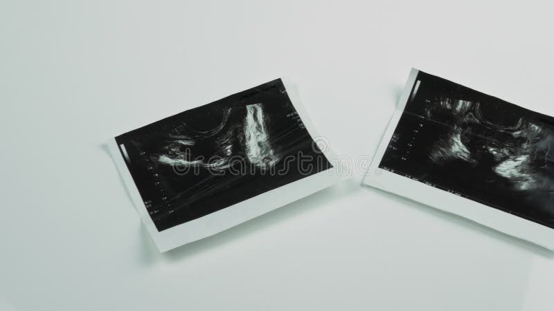 Ultrasound of the Prostate on a White Background, a Picture of a Male ...