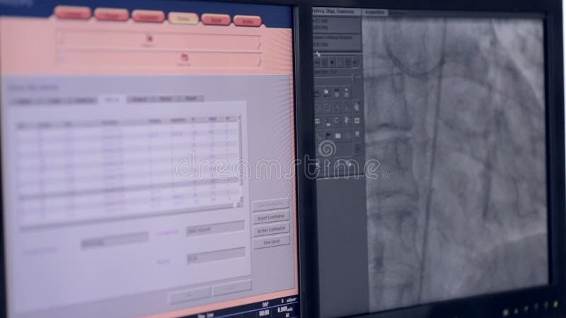 Ultrasound of a Real Heartbeat. Ultrasonic Examination on Computer ...