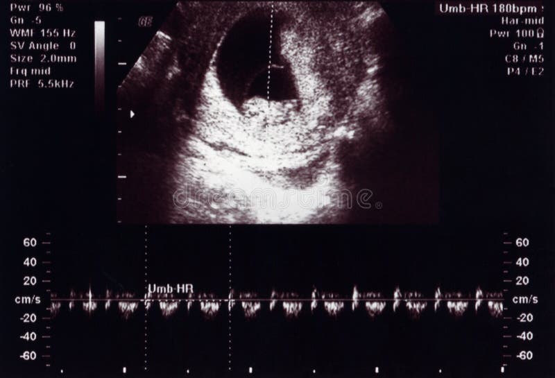 Ultrasound Scan One Month stock image. Image of pregnancy - 5922863