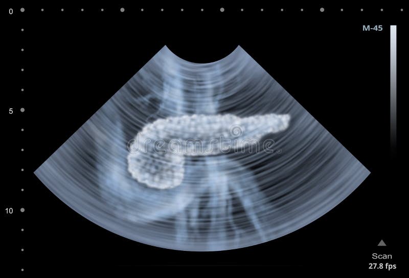 Ultrasound Scan of Human Pancreas Stock Illustration - Illustration of ...