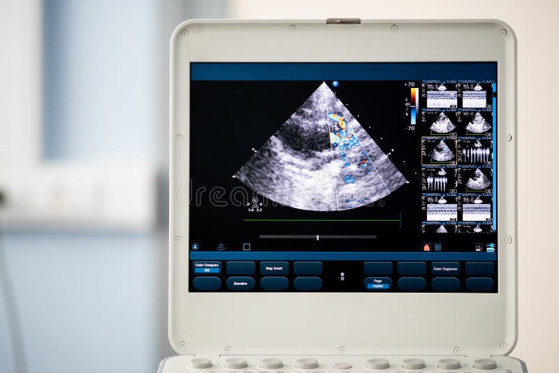 The Ultrasound Screen with the Image of a Heart Scan with a Doppler ...