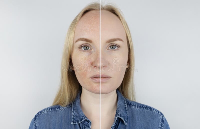 Ultraviolet Rays on Skin. Protective Creams Test. on the Left, the Skin ...