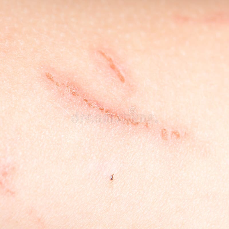 Ferida Na Pele De Uma Pessoa Foto de Stock - Imagem de pessoa, pele ...