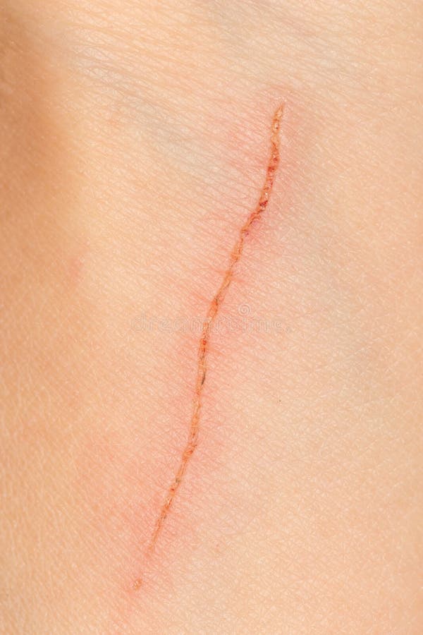 Ferida Na Pele De Uma Pessoa Foto de Stock - Imagem de povos, medicina ...