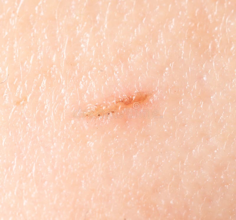 Ferida na pele humana foto de stock. Imagem de cicatriz - 106834232