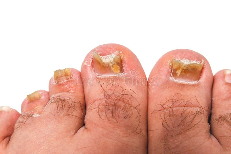 Un Champignon D'ongle De Pied Image stock - Image du santé, médecine ...