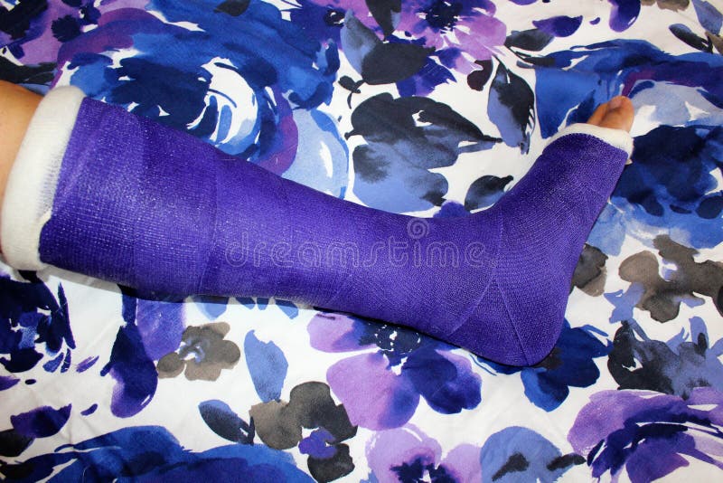 Caviglia Rotta Dopo L'operazione Fotografia Stock - Immagine di ...