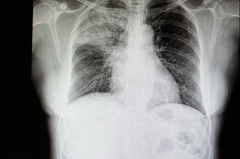 Polmonite Foto Stock - Download 4,616 Royalty Free Photos