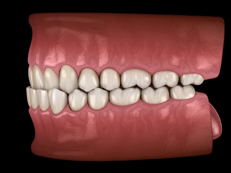 Underbite Dental Occlusion Malocclusion of Teeth . Medically Accurate ...