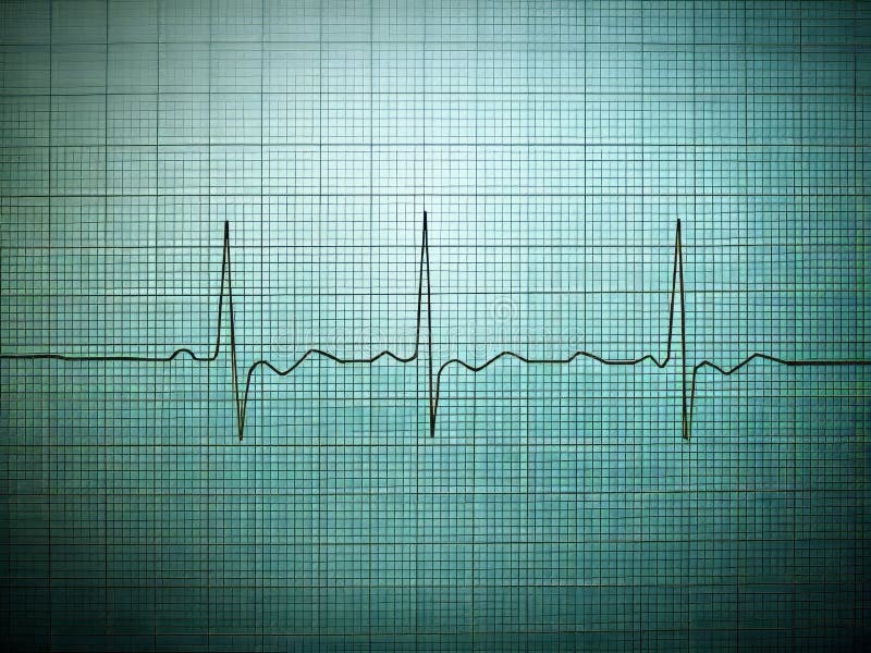 Understanding Atrial Flutter Paroxysm a Minimalist ECG Interpretation ...