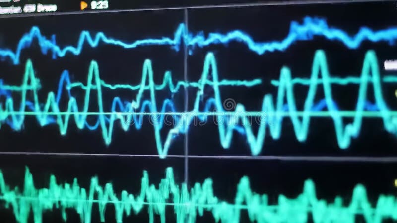 Understanding Brainwave Patterns through Advanced Neurological ...