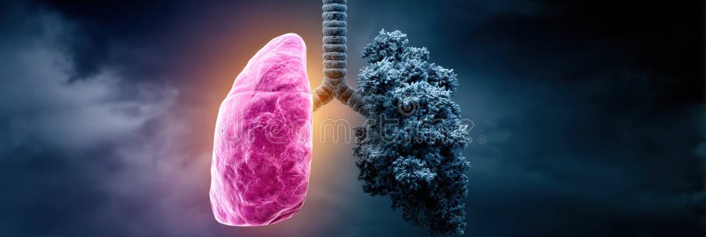Understanding the Differences between Lung Infection and Lung Cancer ...