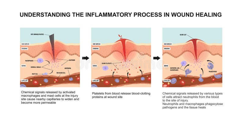 Splinter Skin Stock Illustrations – 53 Splinter Skin Stock ...
