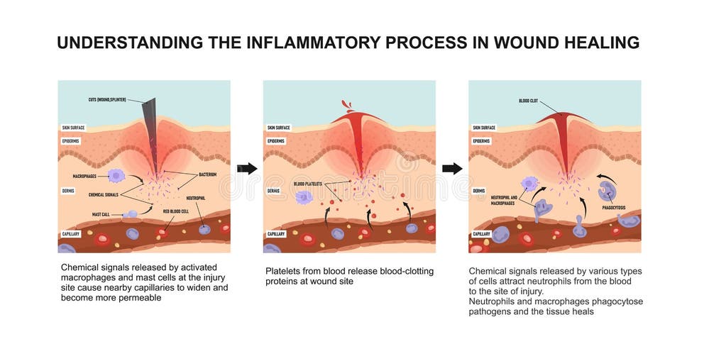 Granulation Wound Stock Illustrations – 23 Granulation Wound Stock ...