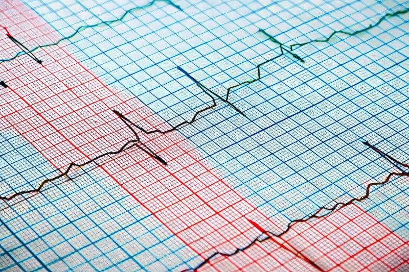 Understanding ST Elevation and Normal ECG Patterns: a Comprehensive ...