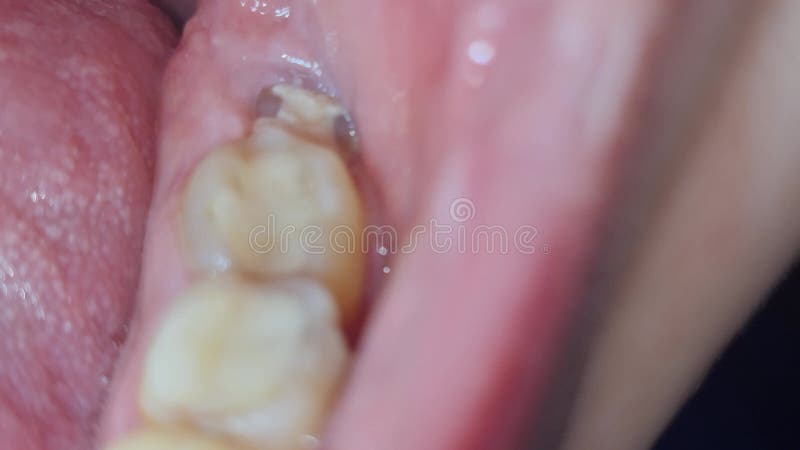 8k Undeveloped Wisdom Teeth in a Male Mouth. Also is Called the Third ...