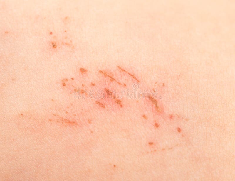 2,945 Blessure Sur La Peau Photos libres de droits et gratuites de ...