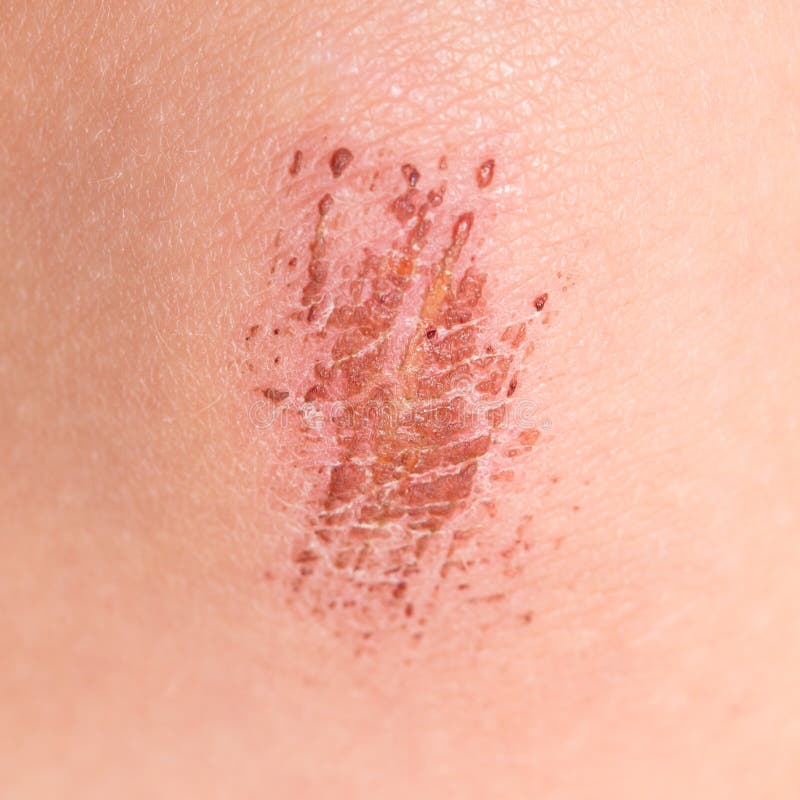 2,945 Blessure Sur La Peau Photos libres de droits et gratuites de ...