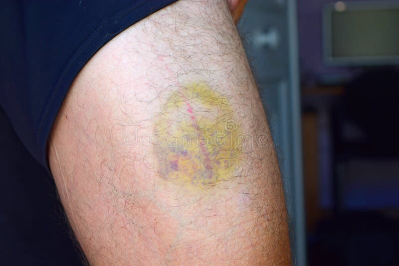 Contusion grave photo stock. Image du patte, genou, physique - 20580846