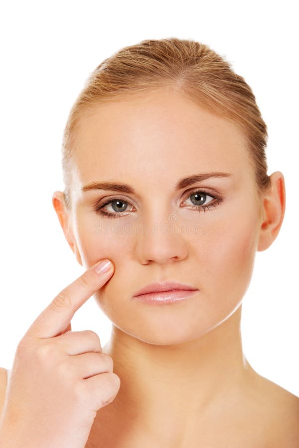Unhappy Young Woman Touching Her Pimple Stock Photo - Image of female ...