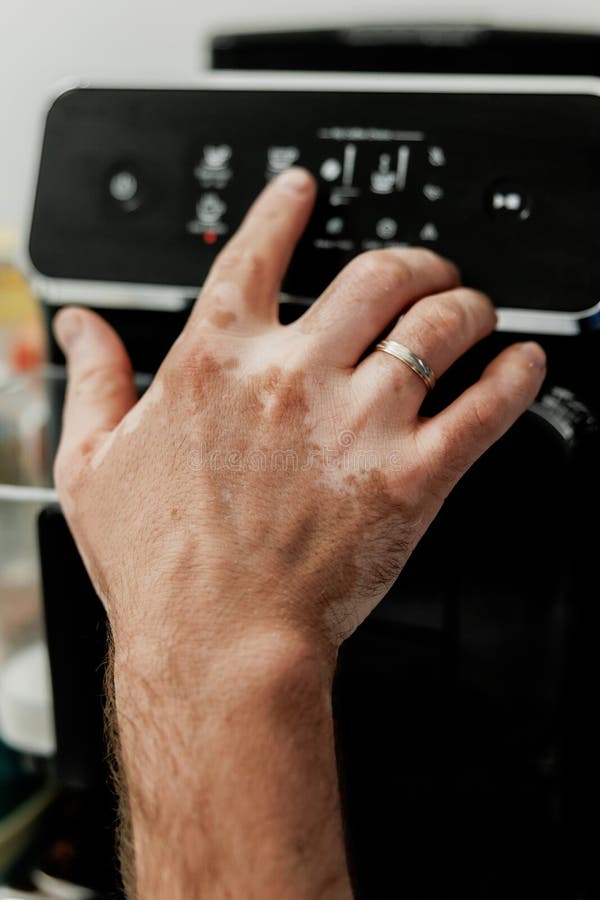 Close Up of a Human Hand with Spots of Vitiligo Disease Operating ...